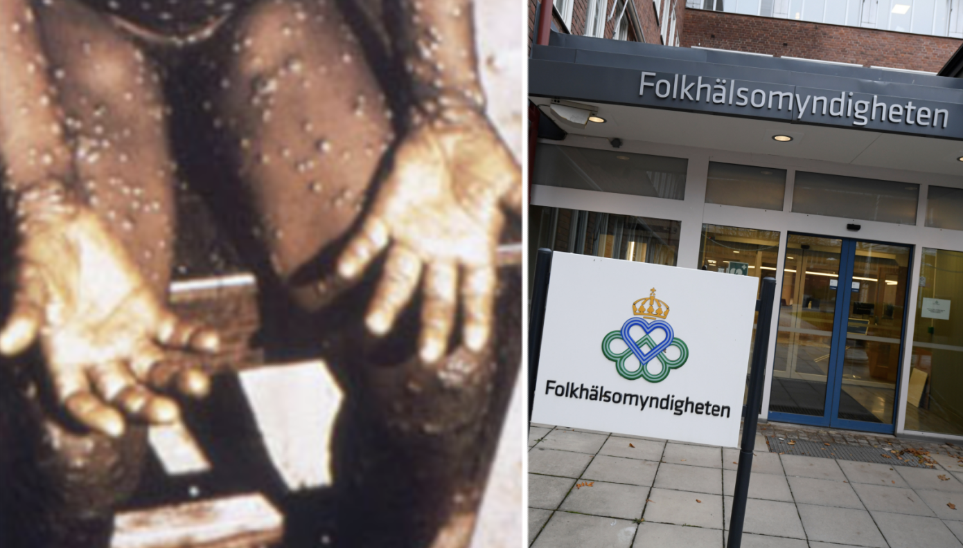 Apkoppor i Sverige: Symtom, behandling och bild på monkeypox