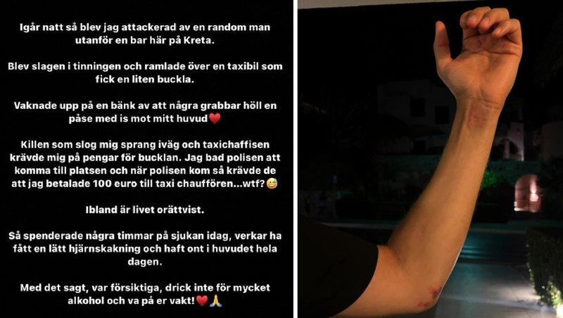 YouTubern Daniel Norlin attackerad på semestern: "Hjärnskakning"