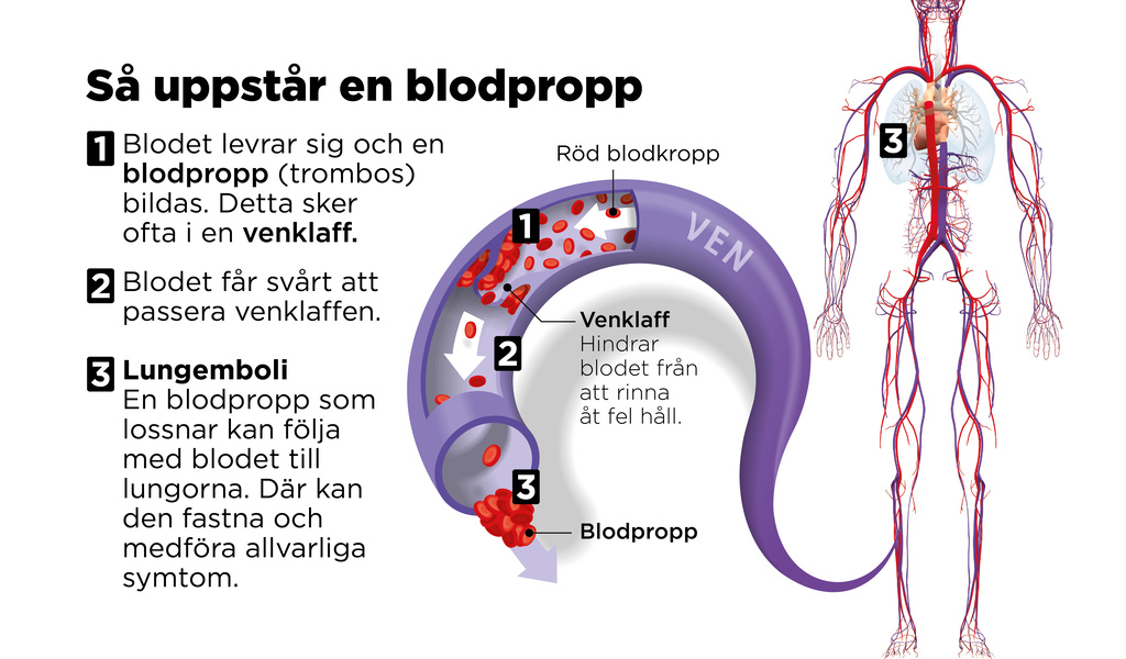 Ökad risk för blodpropp även efter mild covid
