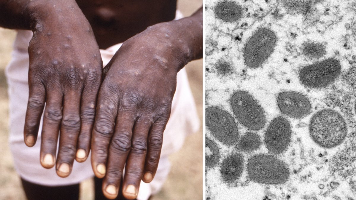 Tredje fallet av apkoppor i Sverige – bekräftat i Stockholm