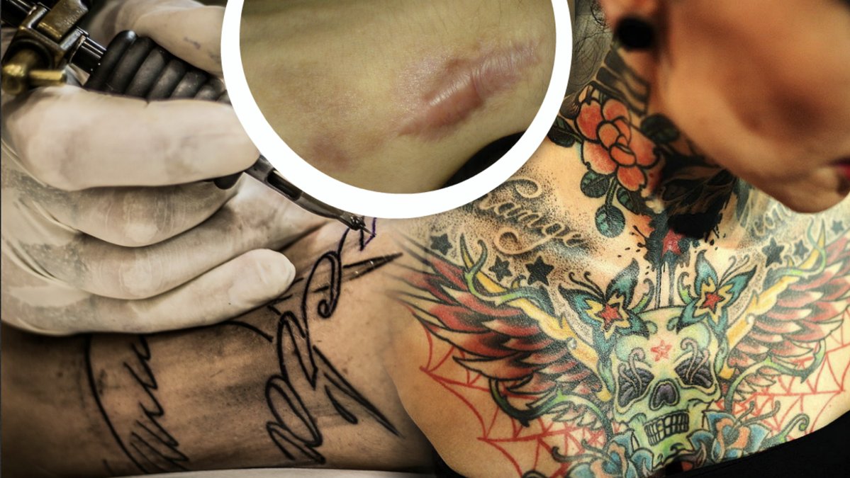 Har du anlag för keloider? Då ska du undvika tatueringar