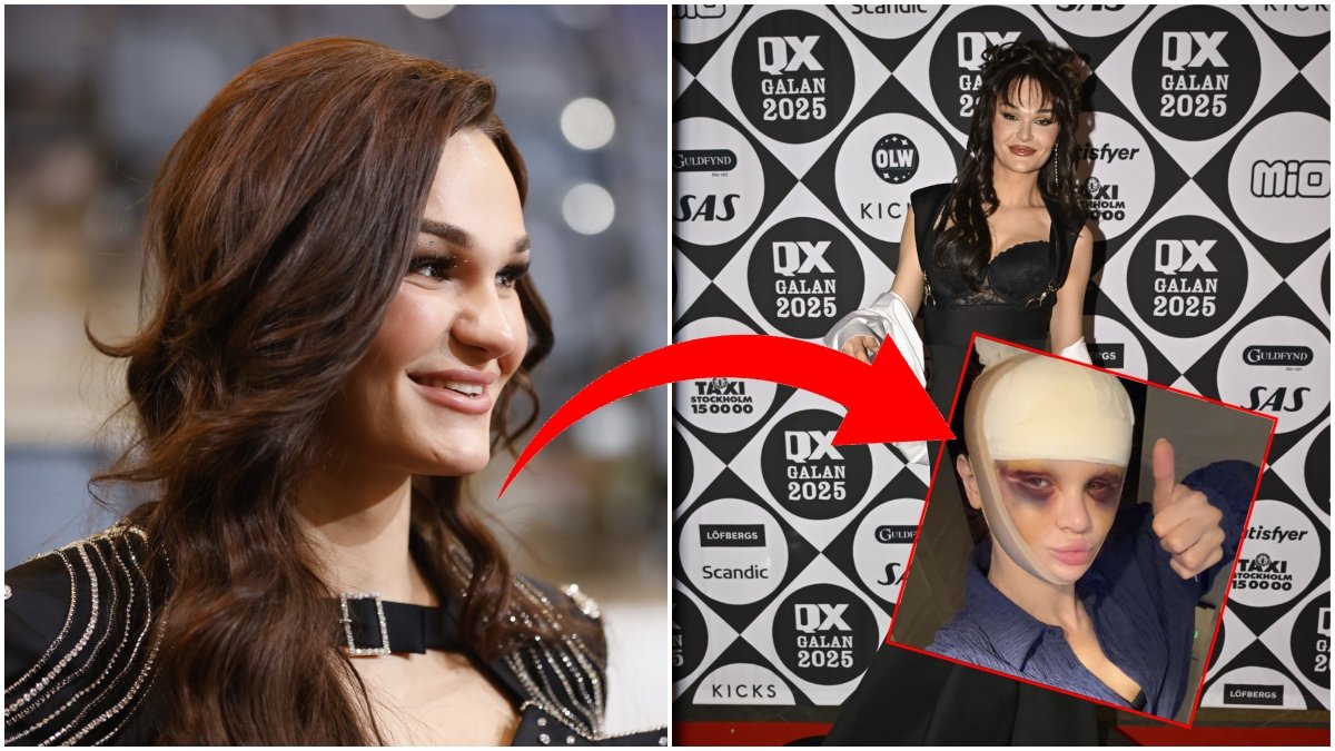 Tone Sekelius får ny operation efter komplikationer