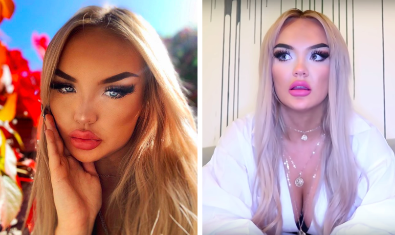 Amanda Lundgren: "Jag har drabbats av breast implant illness"